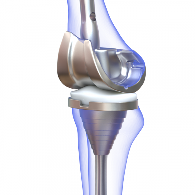 Knee Replacement Implant 3D Model in Anatomy 3DExport