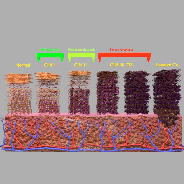 Cervical cancer dysplasia CIN 3D Model in Anatomy 3DExport