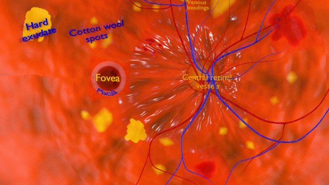 Diabetic eye diseases model 3D Model in Anatomy 3DExport