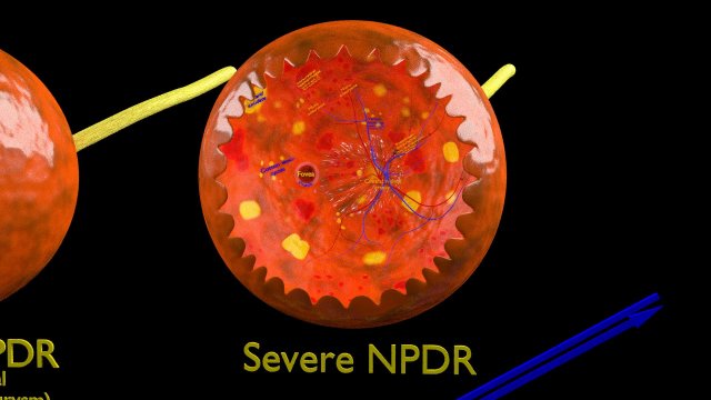 Diabetic eye diseases model 3D Model in Anatomy 3DExport