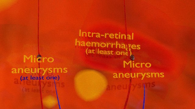 Diabetic eye diseases model 3D Model in Anatomy 3DExport