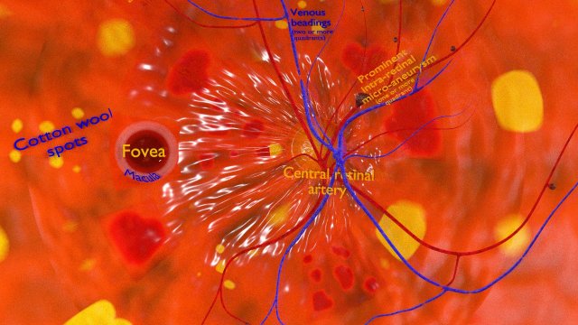 Diabetic eye diseases model 3D Model in Anatomy 3DExport