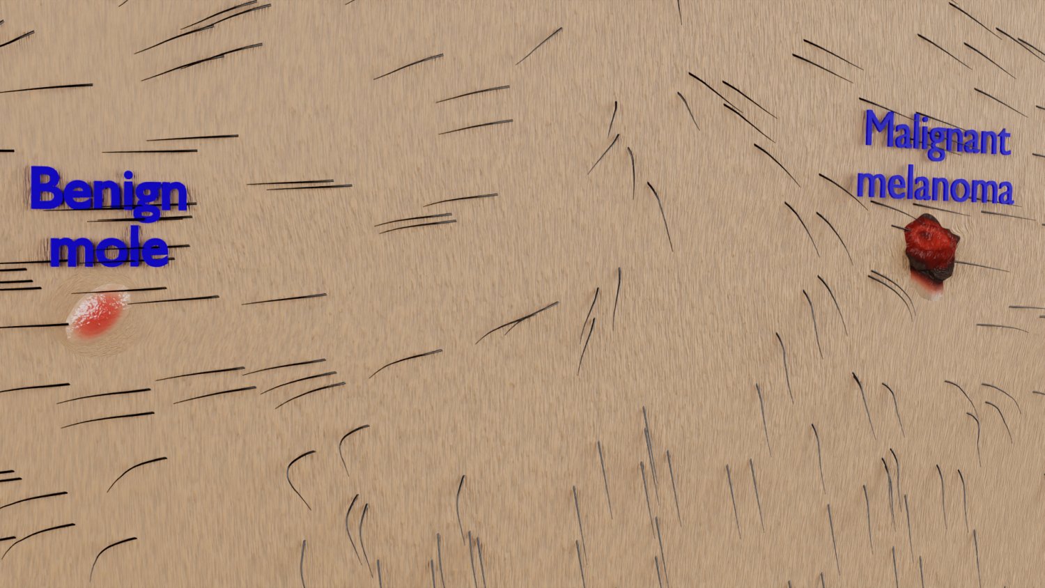 Melanoma Mole Benign