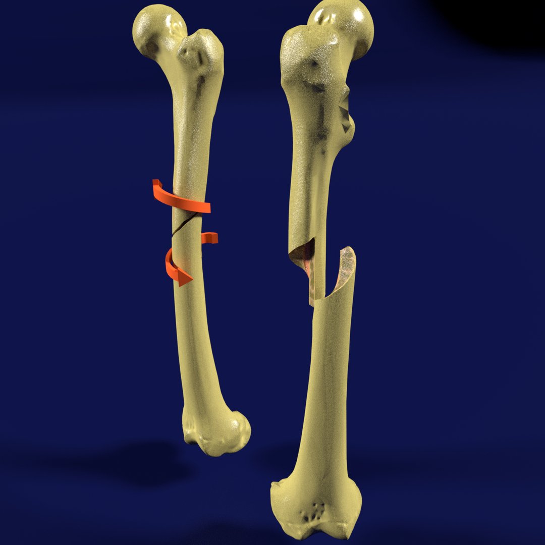 Spiral Fracture skeleton labelled femur 3D-Modell in Anatomie 3DExport