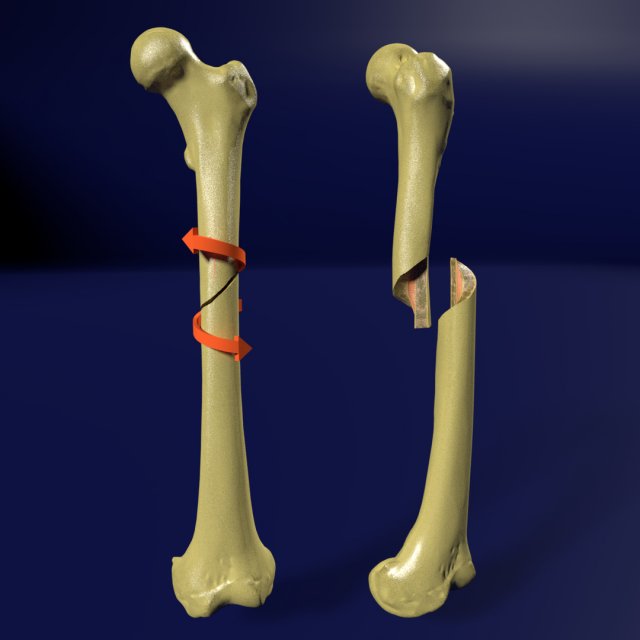 Spiral Fracture skeleton labelled femur 3D-Modell in Anatomie 3DExport