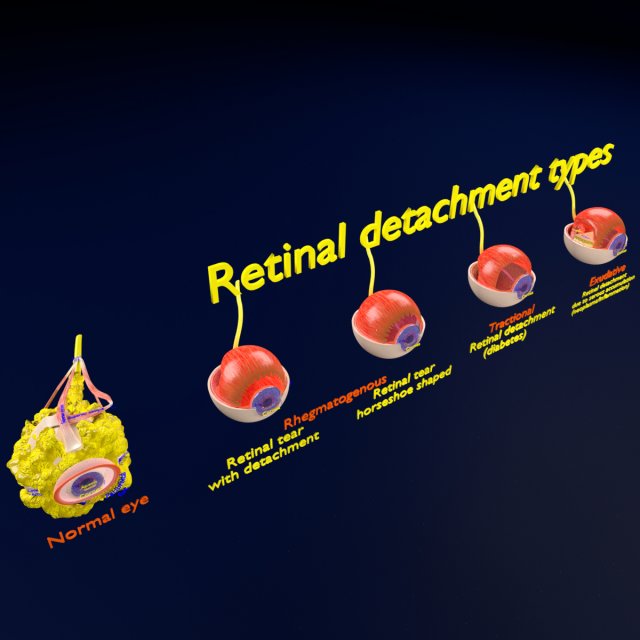 Retinal detachment types eye 3D Model in Anatomy 3DExport