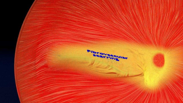 Retinal detachment types eye 3D Model in Anatomy 3DExport