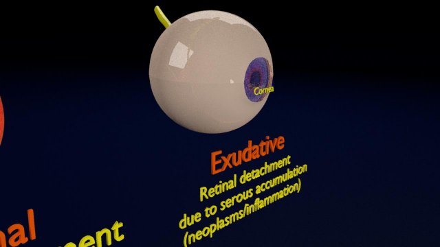 Retinal detachment types eye 3D Model in Anatomy 3DExport