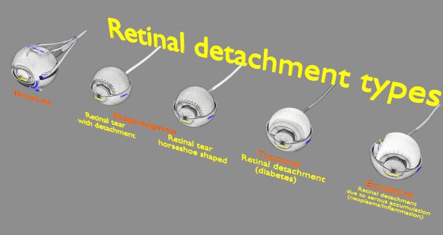 Retinal detachment types eye 3D Model in Anatomy 3DExport