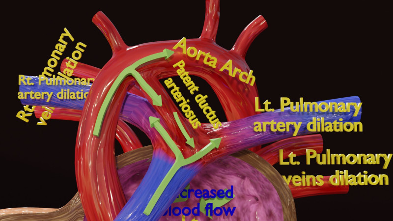 PDA Patent Ductus Arteriosus vs Normal blood circulation 3D Model in ...