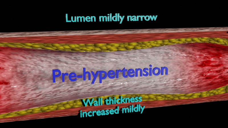 Hypertension blood vessel artery structural change 3D Model in Anatomy ...