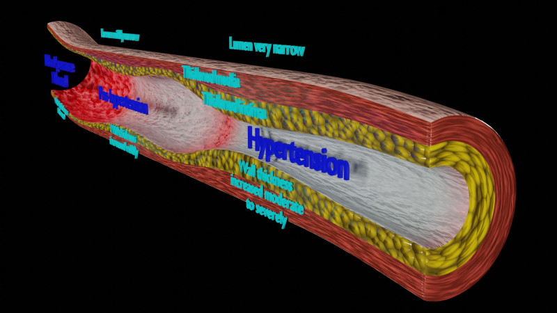 Hypertension blood vessel artery structural change 3D Model in Anatomy ...