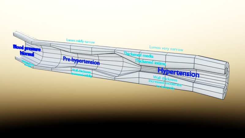 Hypertension blood vessel artery structural change 3D Model in Anatomy ...