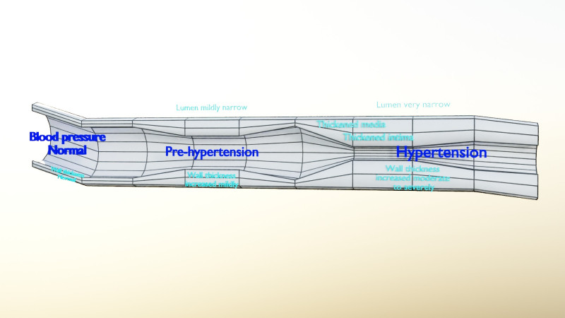 Hypertension blood vessel artery structural change 3D Model in Anatomy ...
