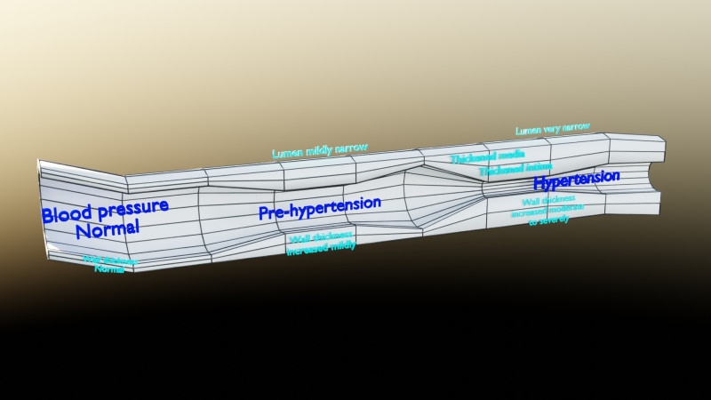 Hypertension blood vessel artery structural change 3D Model in Anatomy ...