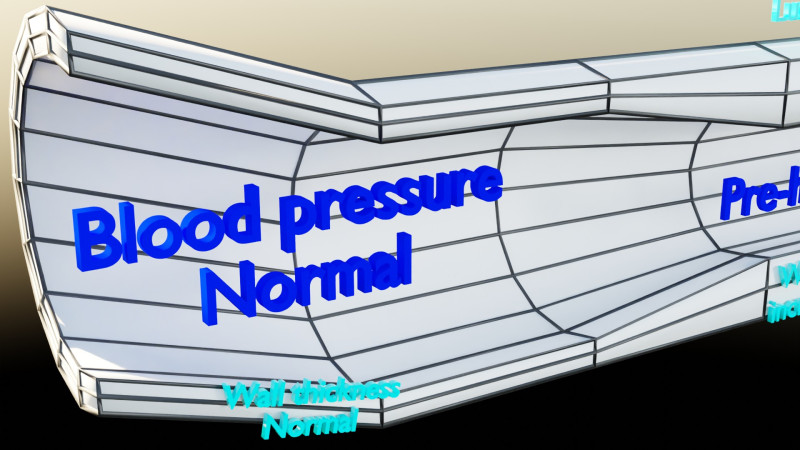 Hypertension blood vessel artery structural change 3D Model in Anatomy ...