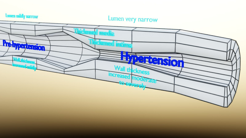 Hypertension blood vessel artery structural change 3D Model in Anatomy ...
