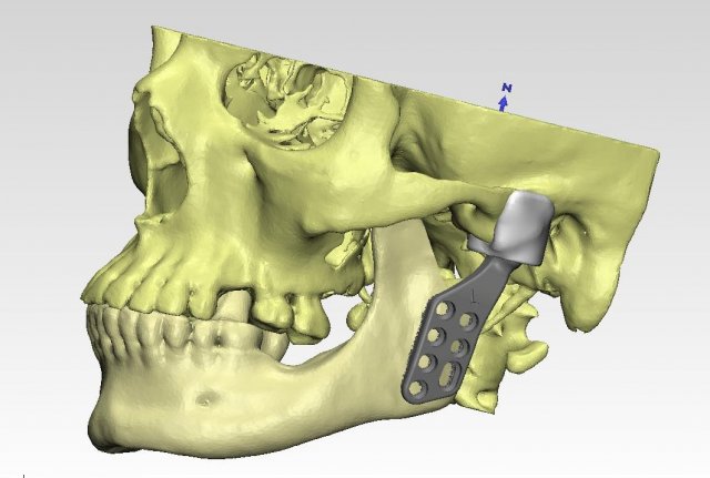 individual tmj prosthesis real operation 3D Model in Medical Equipment ...