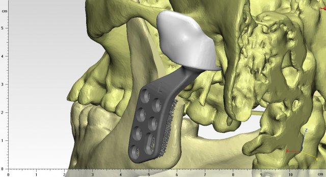 individual tmj prosthesis real operation 3D Model in Medical Equipment ...