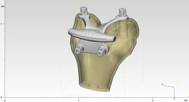 knee joint prosthesis with guides sample of individual prosthetics ...