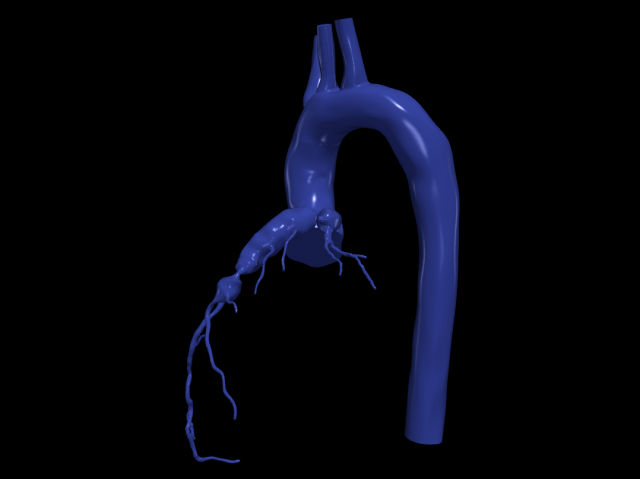 Coronary arteries and aorta 3D Model in Medicines 3DExport